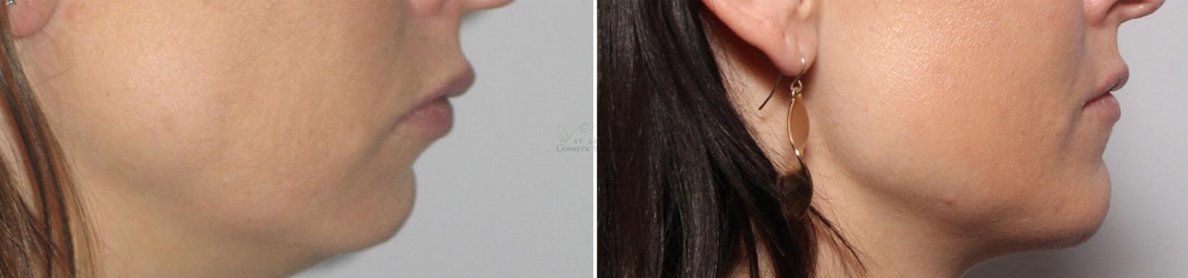 Chin Enhancement Before and After Pictures Case 57 | St. Louis, MO | St ...